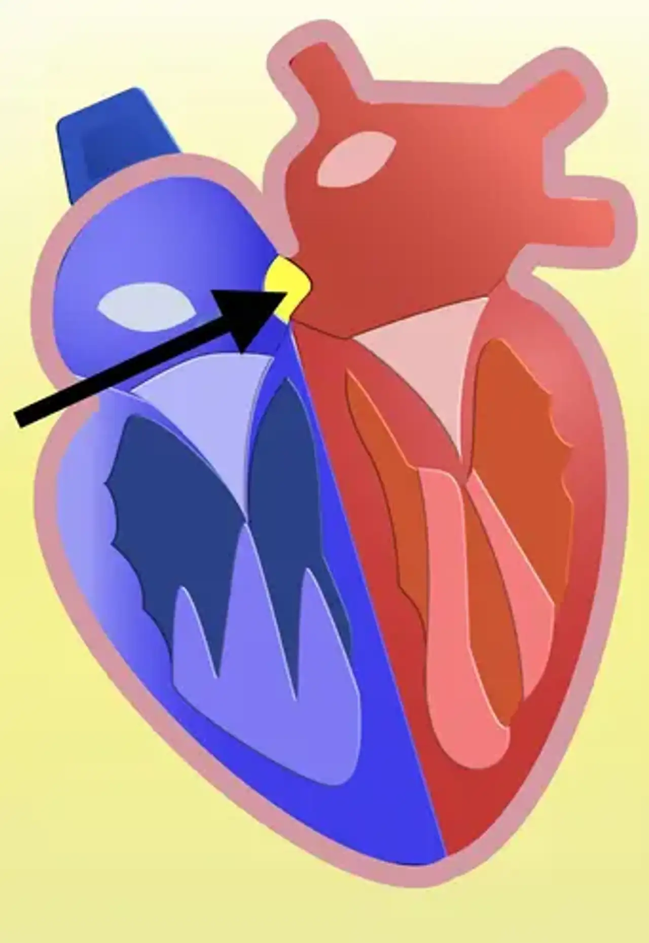 Comunicación interauricular (CIA)