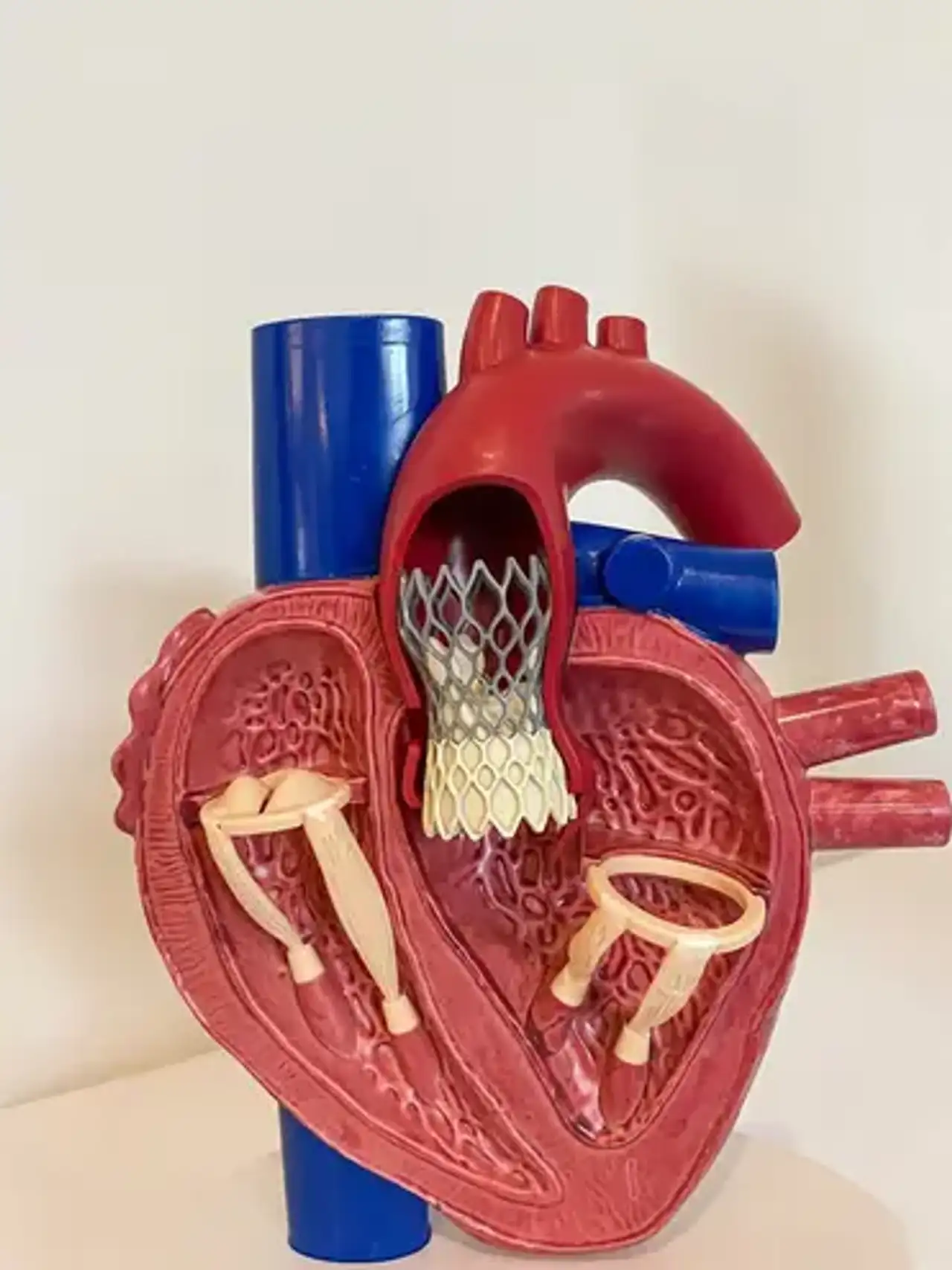 Transkateter Implan Katup Aorta (TAVI)