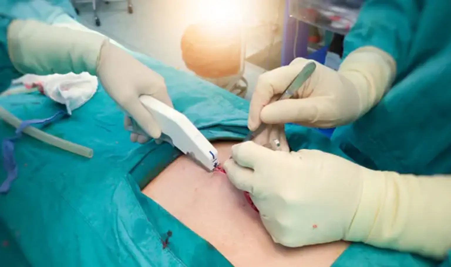 Laparotomy Surgery