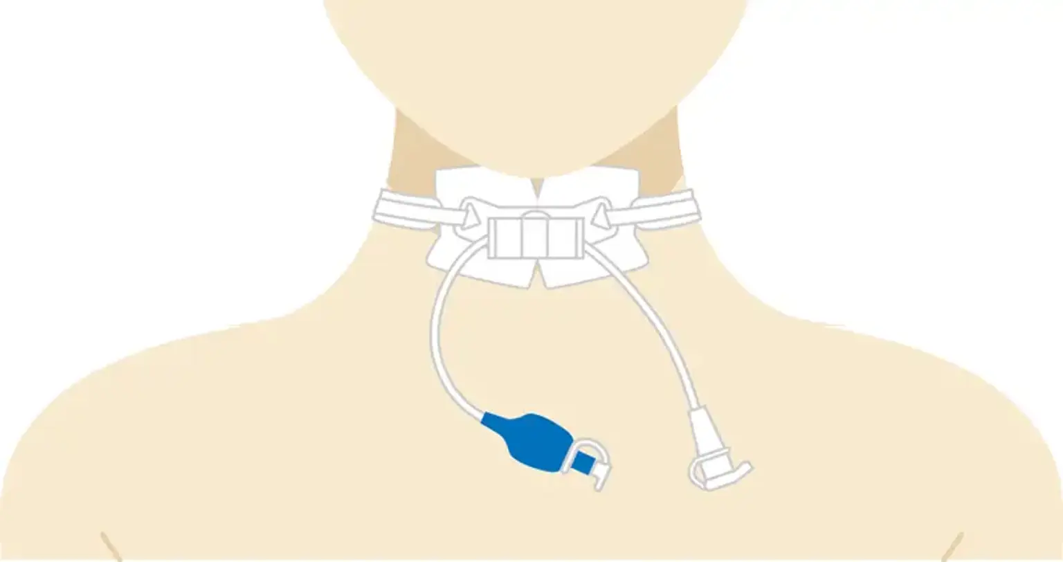 Tracheostomy Procedure