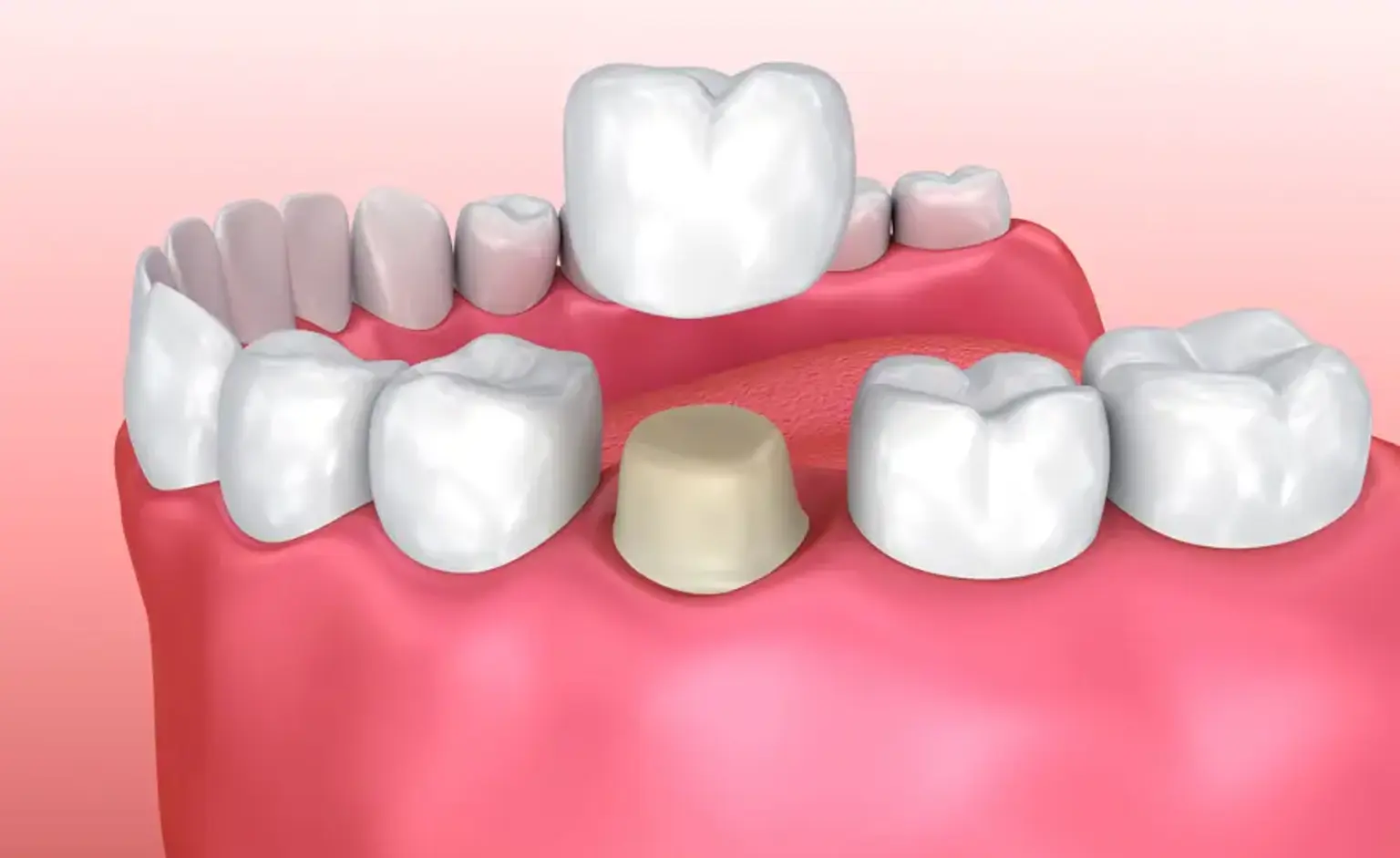 The Process of Dental Crown Placement in Korea: A Comprehensive Patient ...