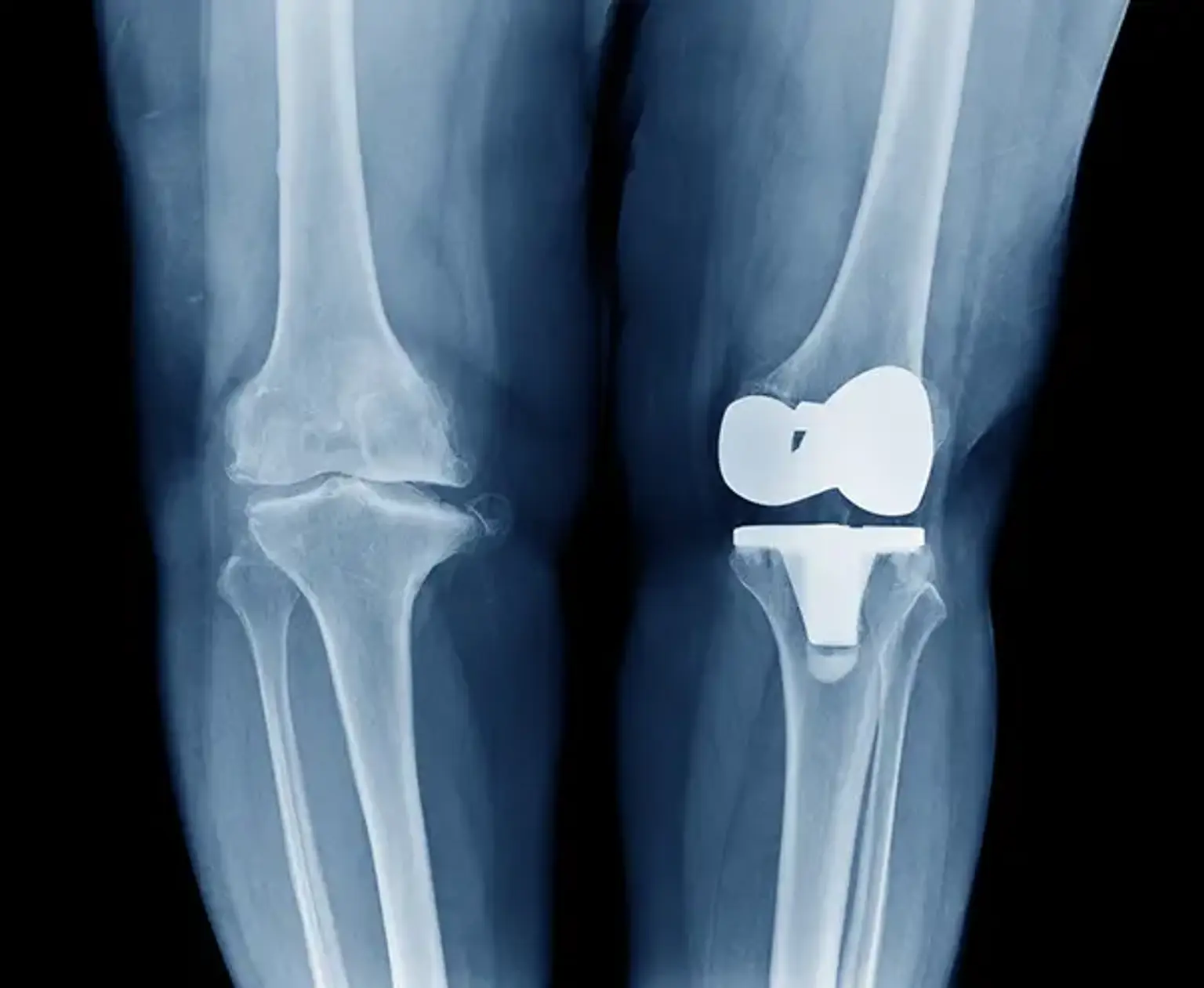 High Tibial Osteotomy in Korea: Patient Guide & Top Clinics