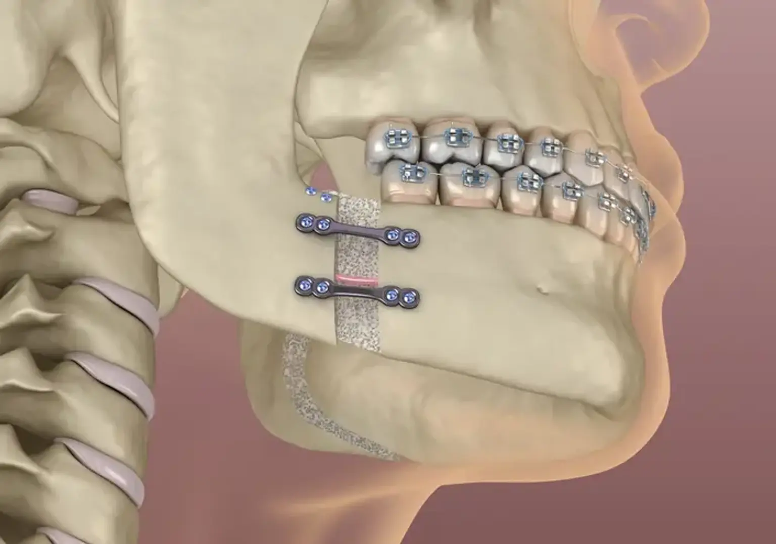 Bone Reshaping Surgery (Osteotomy)