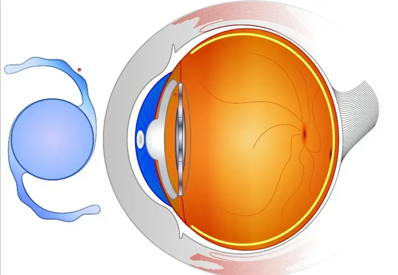 Toric Multifocal Lens Implantation Surgery