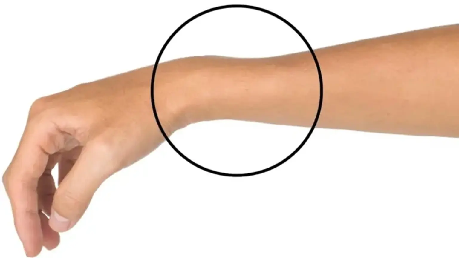 Understanding Colles' Fracture: Causes, Symptoms, and How It's Treated