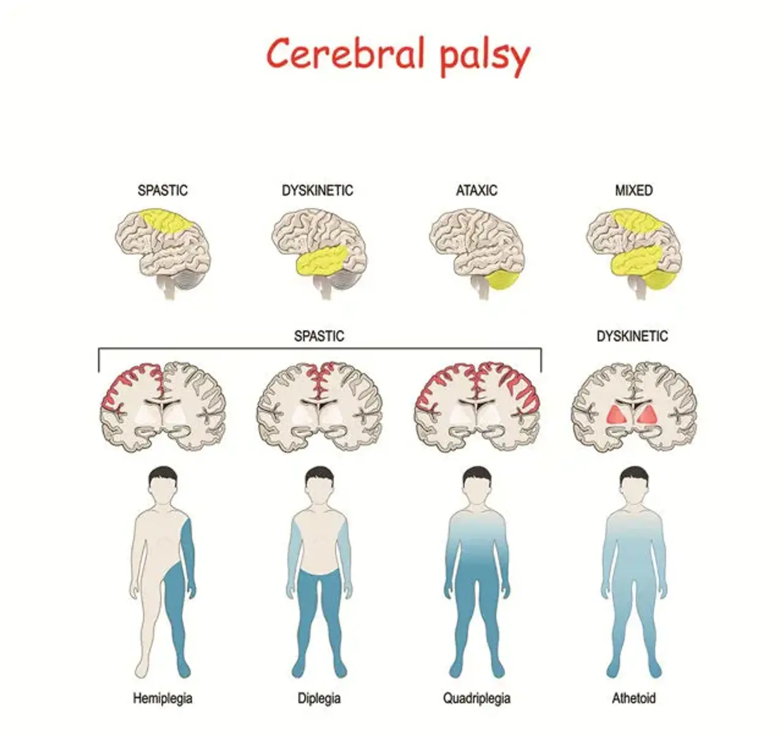 Cerebral Palsy Treatment and Rehabilitation