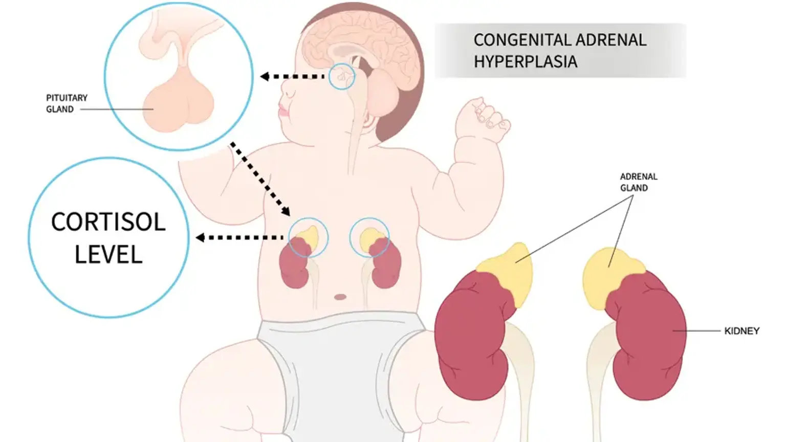 What is Congenital Adrenal Hyperplasia?