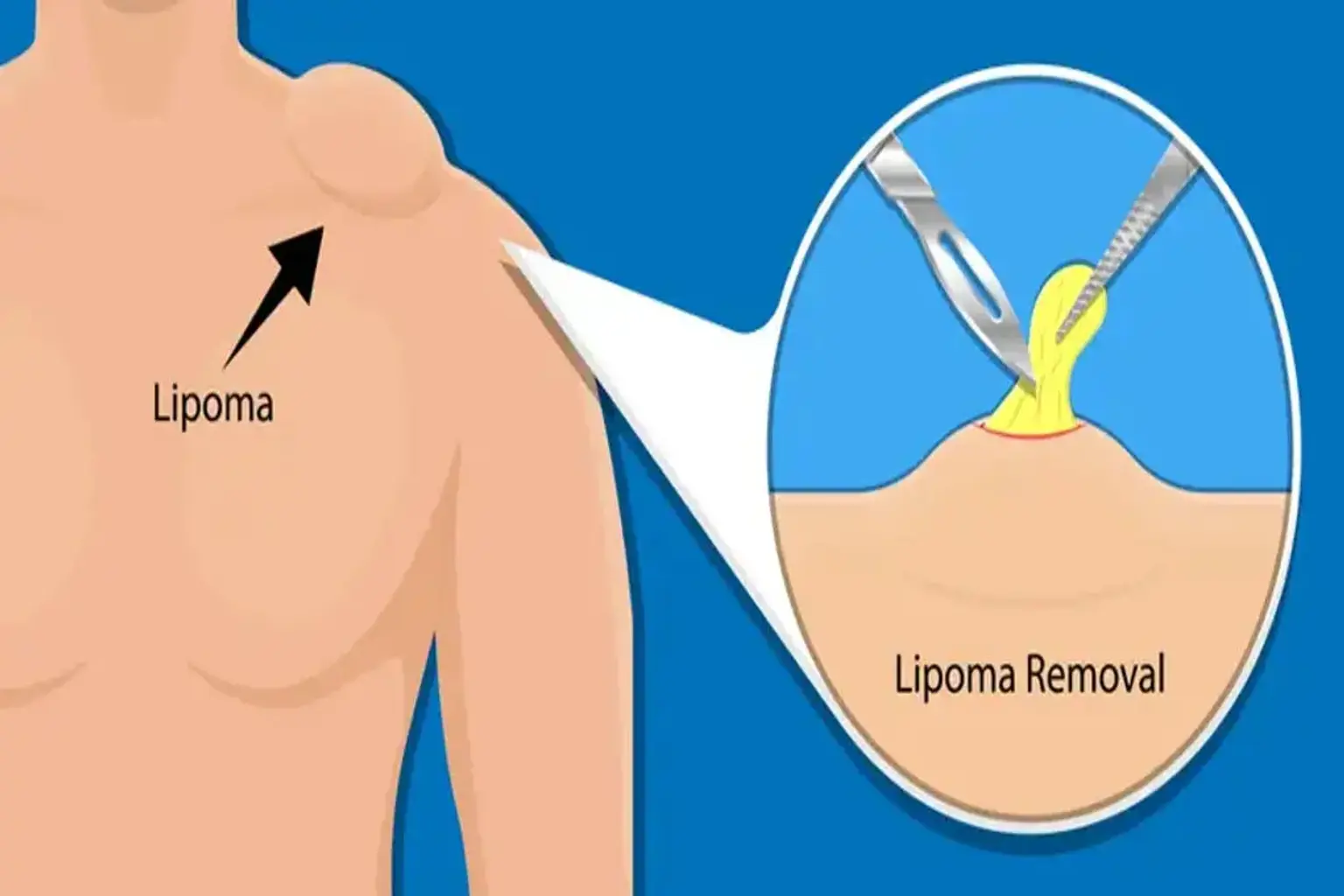 A Comprehensive Patient Guide to Lipoma Removal