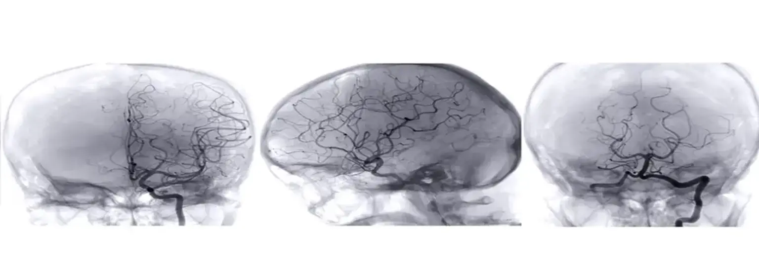What to Expect from a Cerebral Angiography: A Patient's Guide