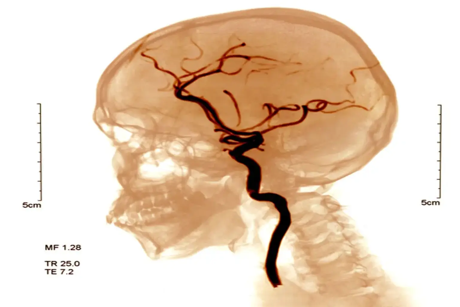 What to Expect from a Cerebral Angiography: A Patient's Guide