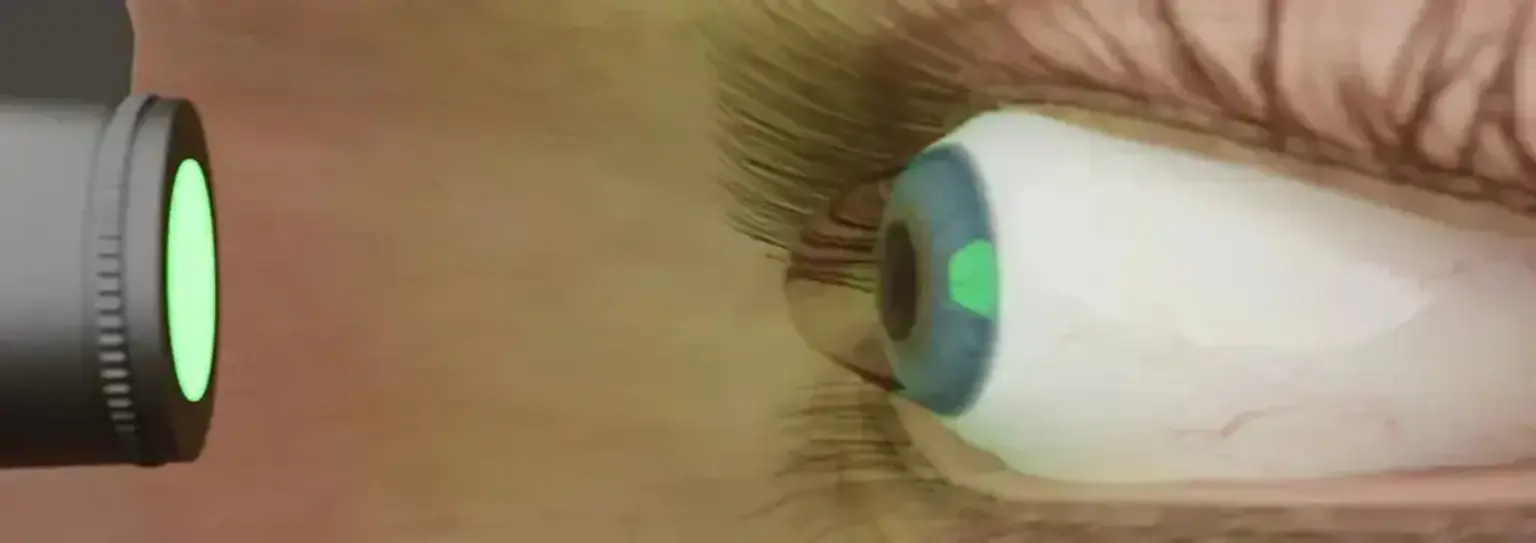 Keratoconus vs. Astigmatism: Understanding the Difference and Treatment ...