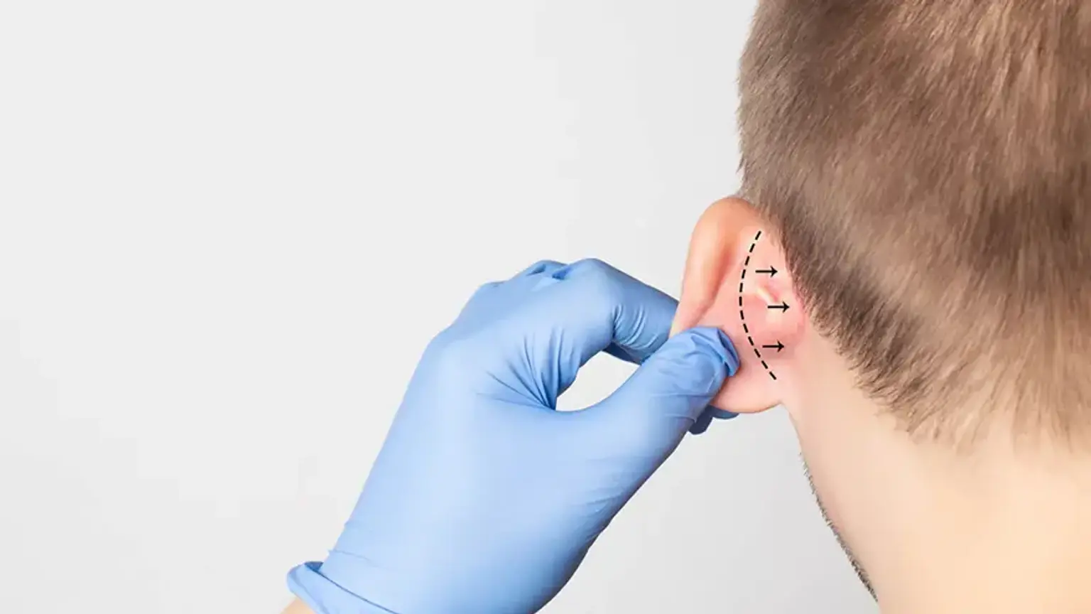 Ear Reshaping Surgery (Otoplasty) in Korea: A Guide to Correcting ...