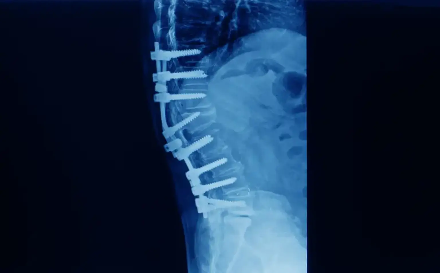 Spinal Fusion Surgery in Korea: What to Expect and How to Prepare