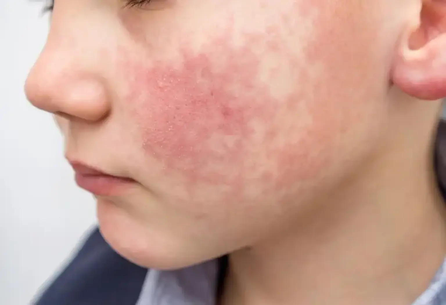 What is Angioedema?