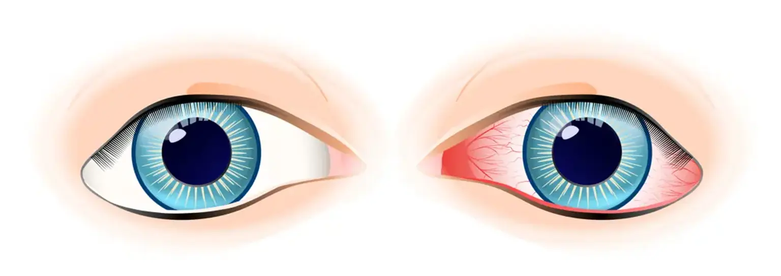 A Comprehensive Guide to Recovery After Uveitis Treatment in Korea