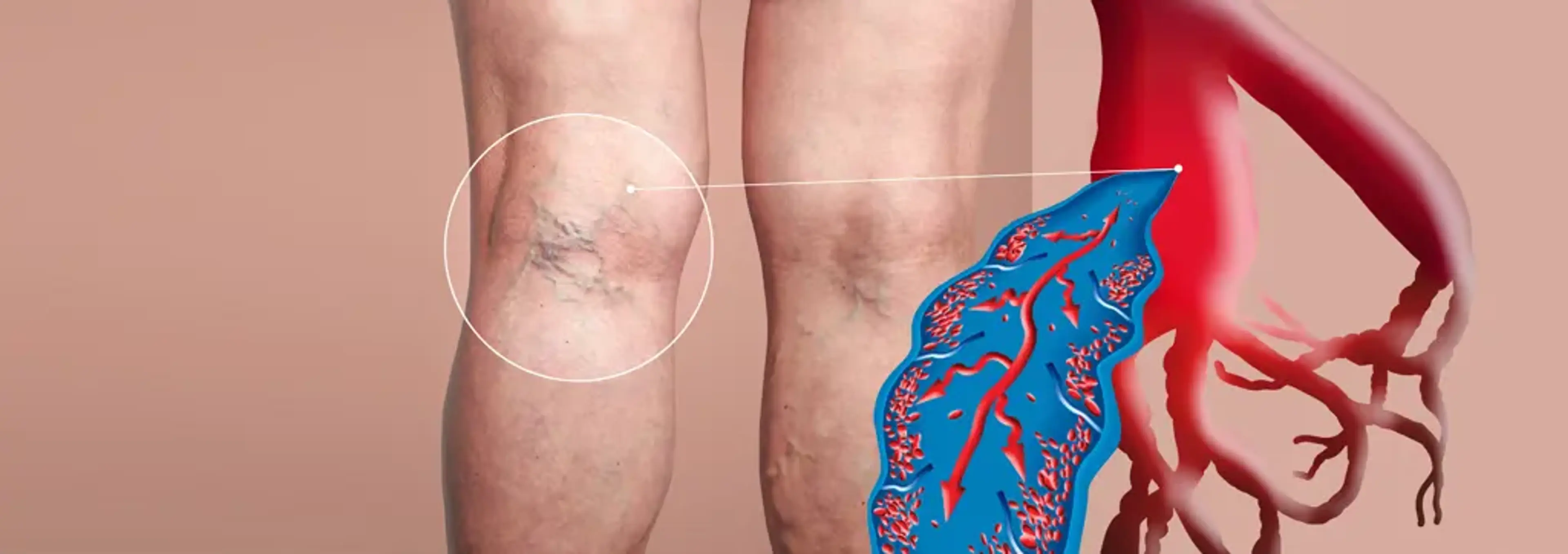 Articles | Vein Ligation Surgery: When Is It Recommended for Severe ...