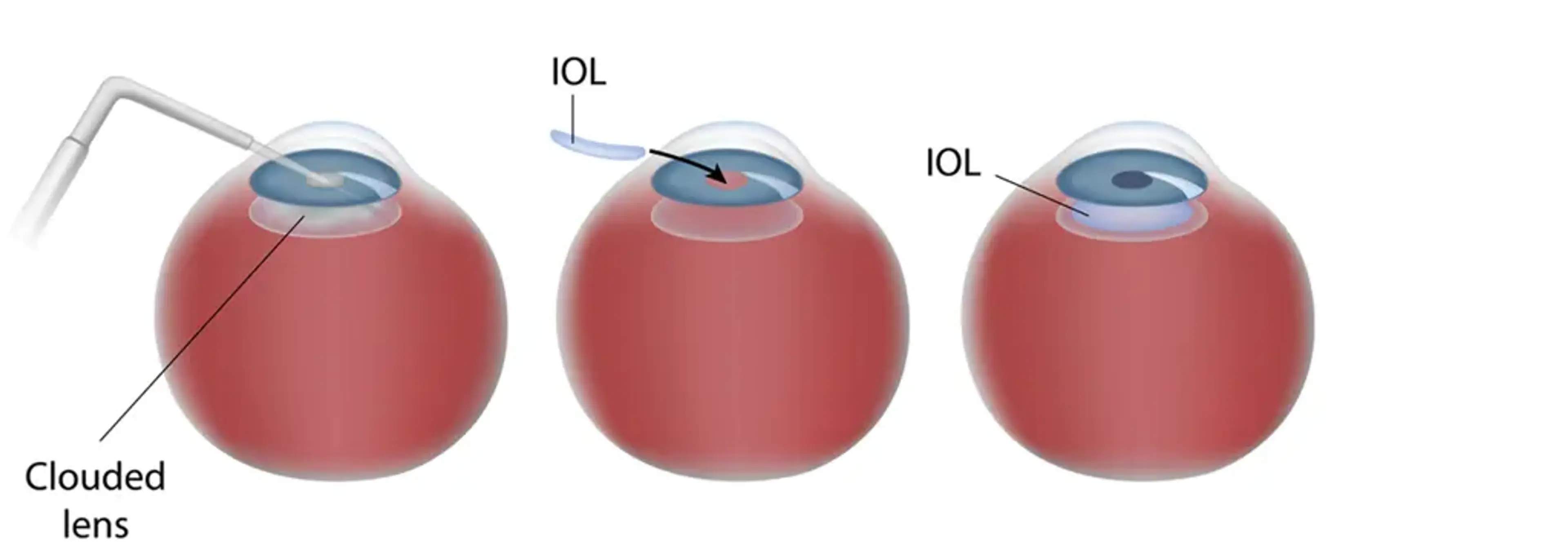 Articles | When Is the Right Time for Cataract Surgery? Your Complete Guide
