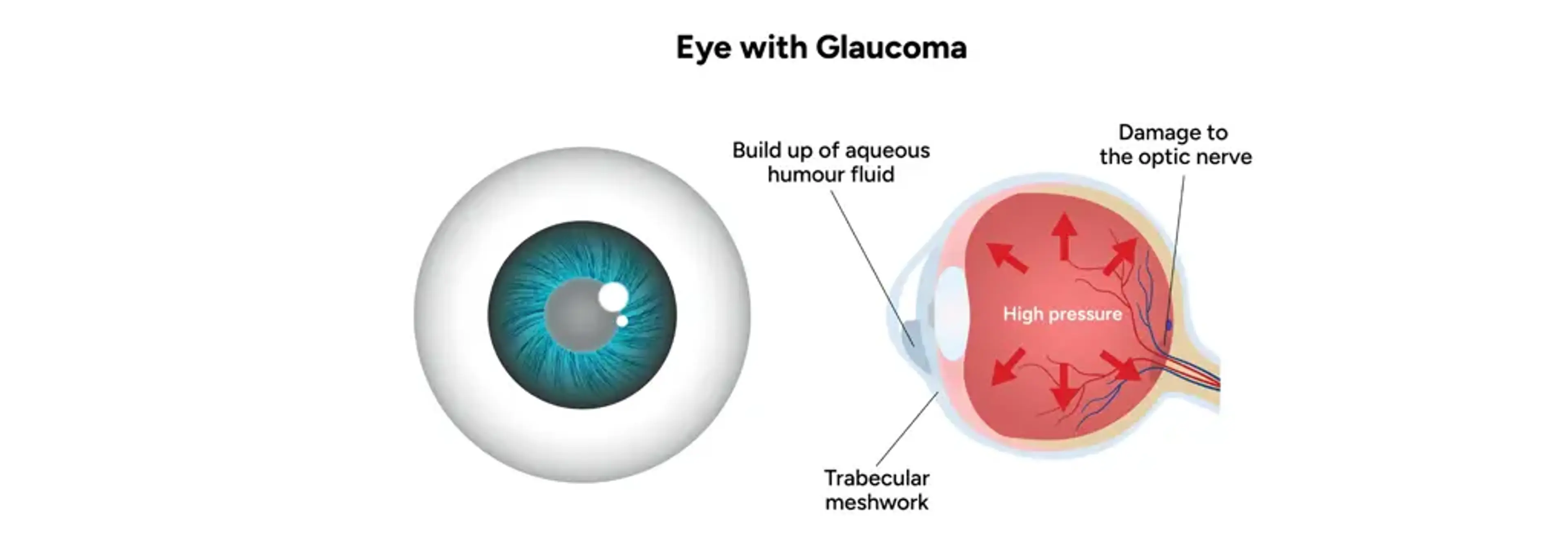 Articles | Effective Glaucoma Treatments: Eye Drops, Laser Therapy ...