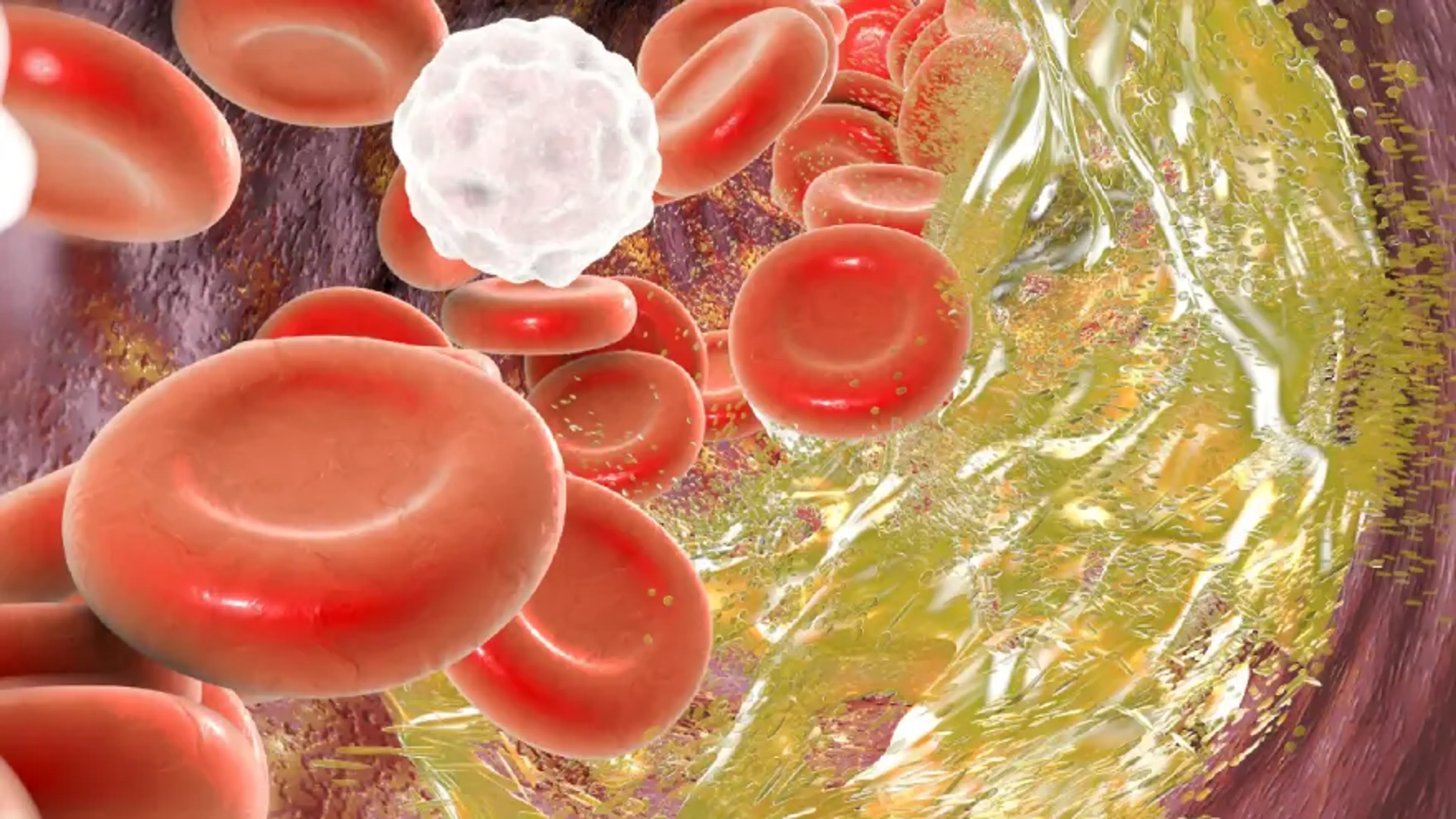 Articles | How High Cholesterol Increases Heart Attack Risk & How to ...