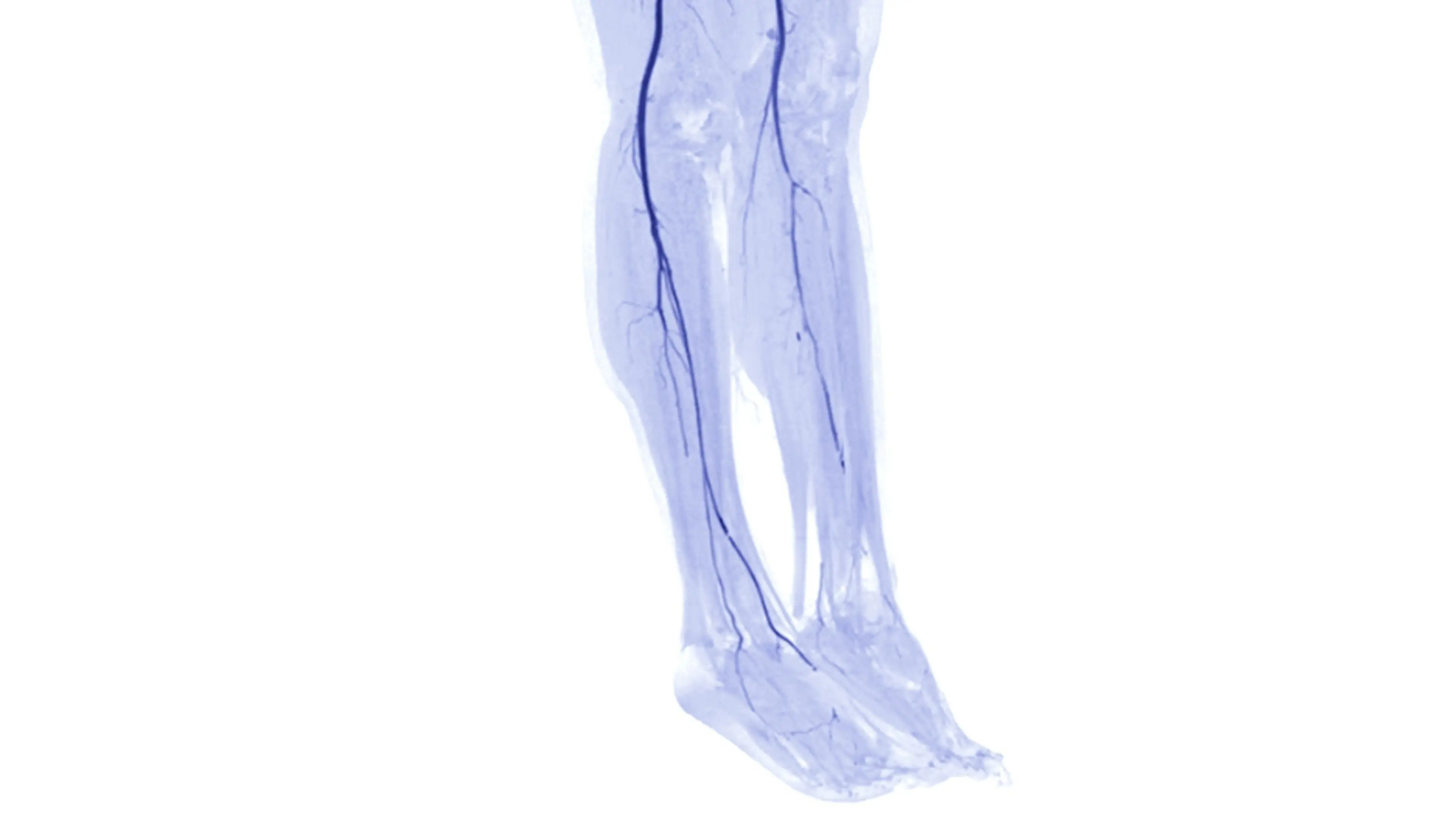 Peripheral Circulatory Disorders