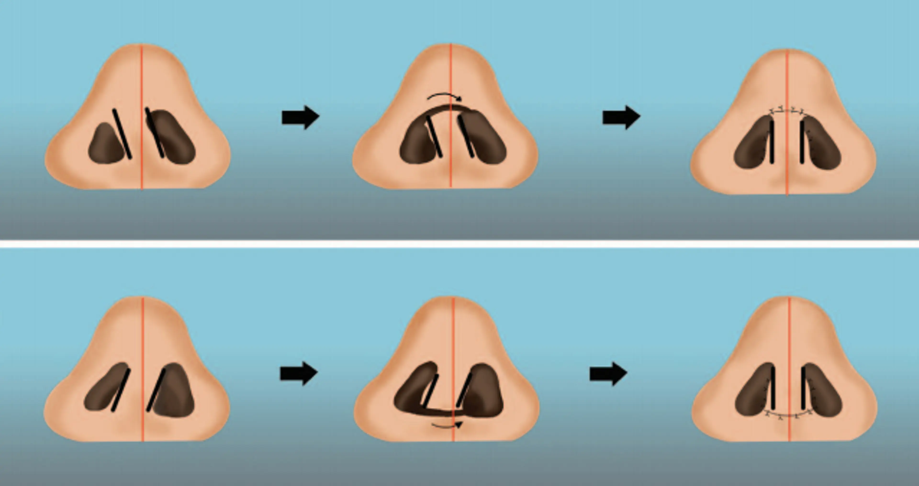 Columella Rotation Flap Techniques for Correction of Columellar Deviations