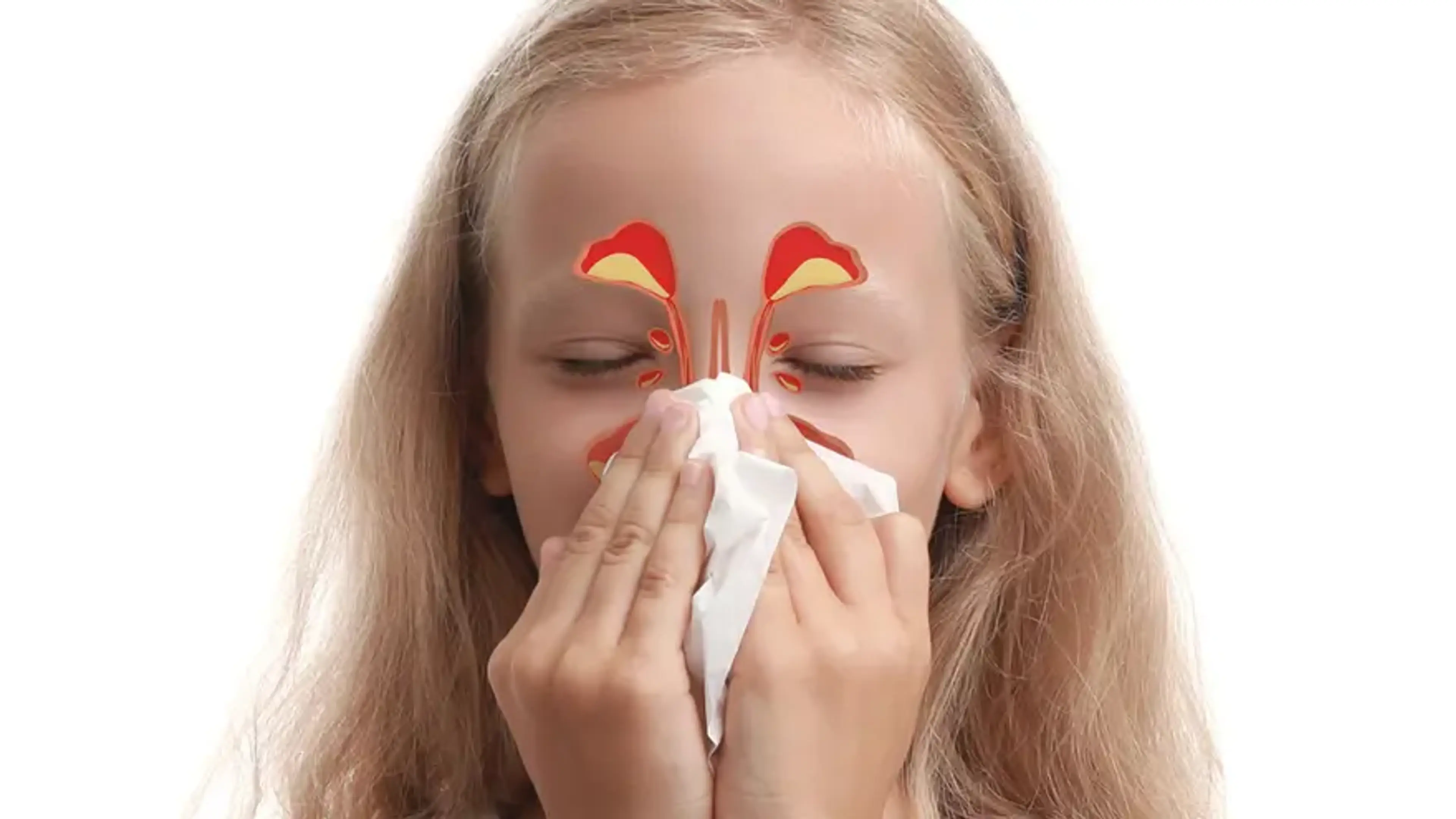 Articles | Sinusitis in Children: Preventive Measures for Respiratory ...