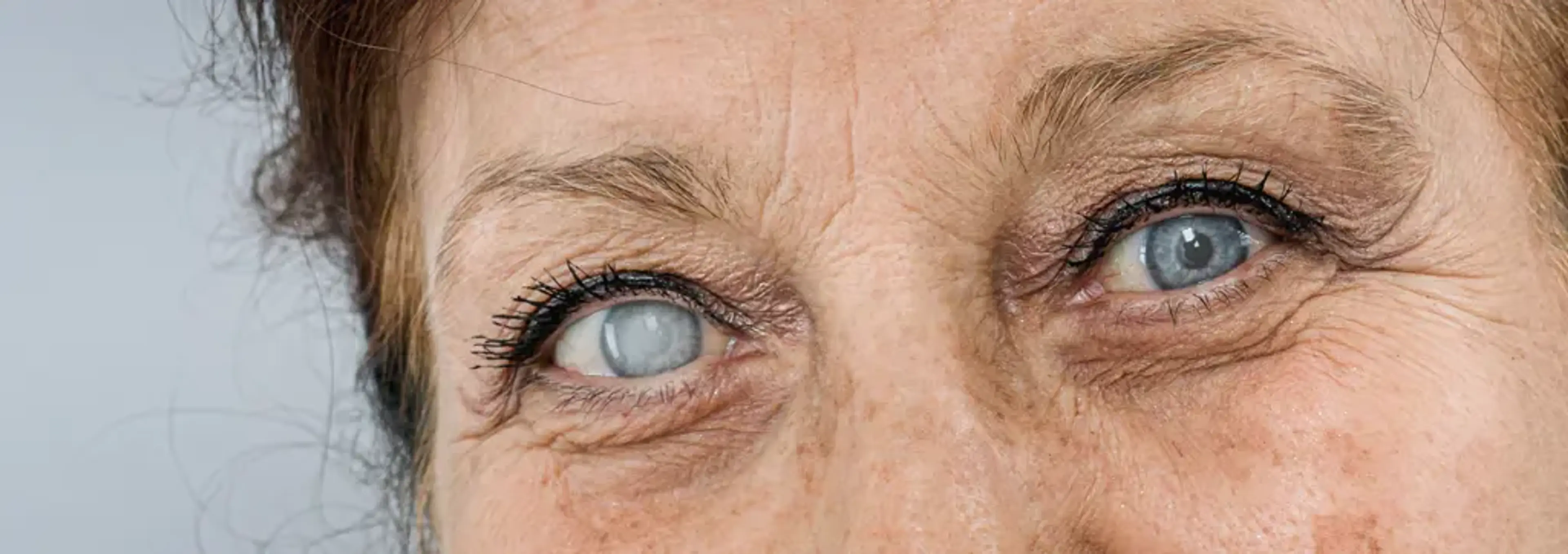 Articles | Early-Onset Cataracts: Causes, Symptoms & Treatment