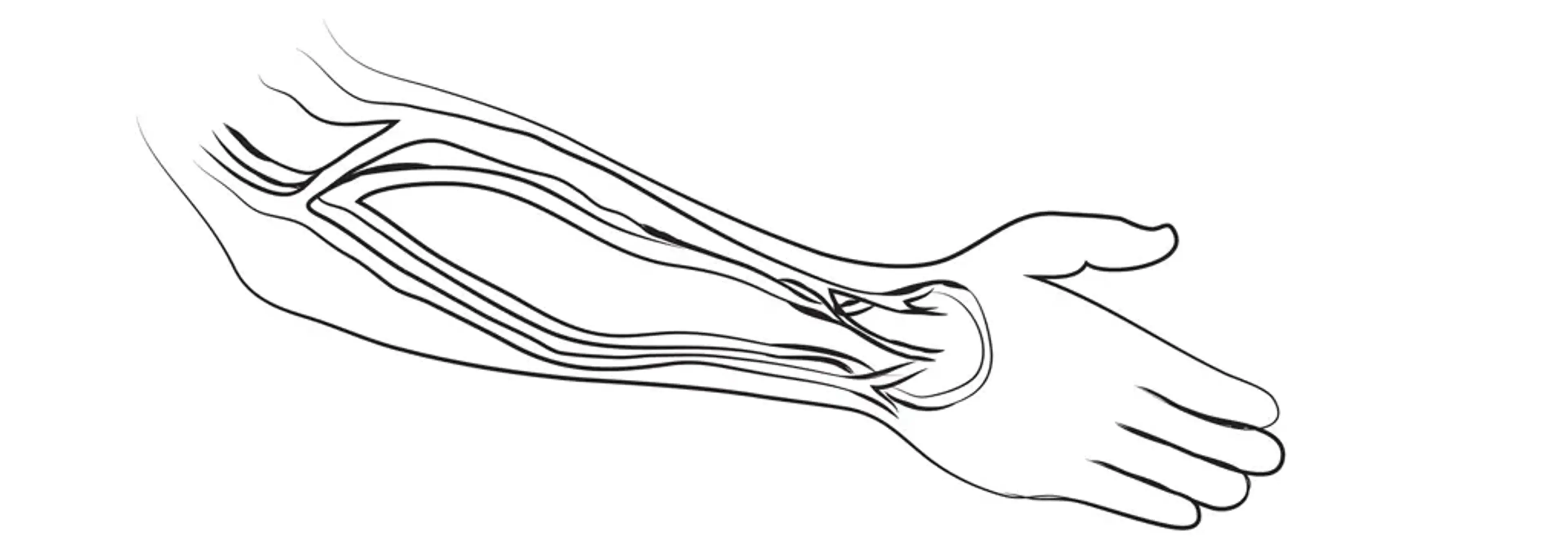 Articles | How Long Does an AV Fistula Last? Understanding Its Lifespan