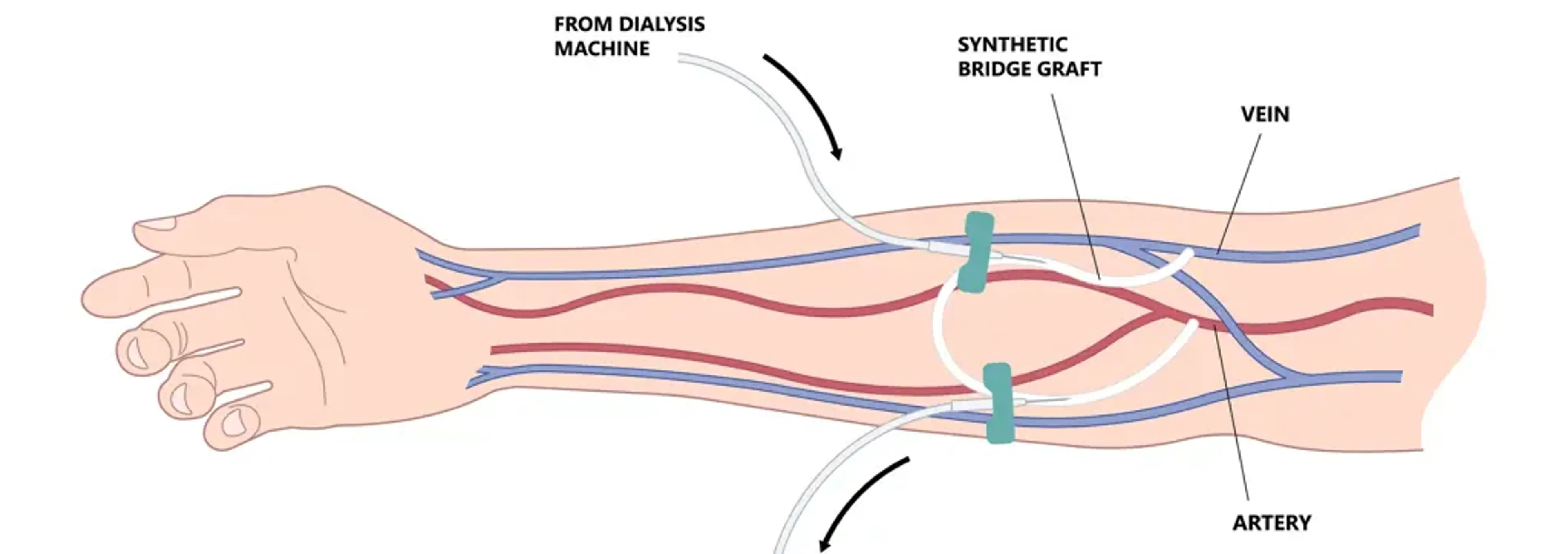 Articles | What Is the Best Aftercare for Arteriovenous Fistula Surgery?